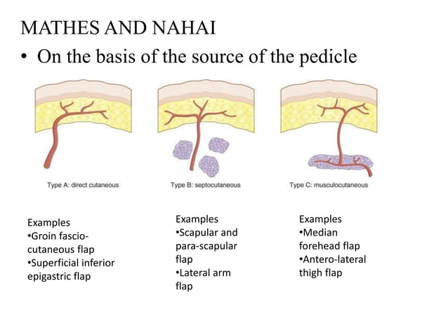 Classification of flaps | PPTX