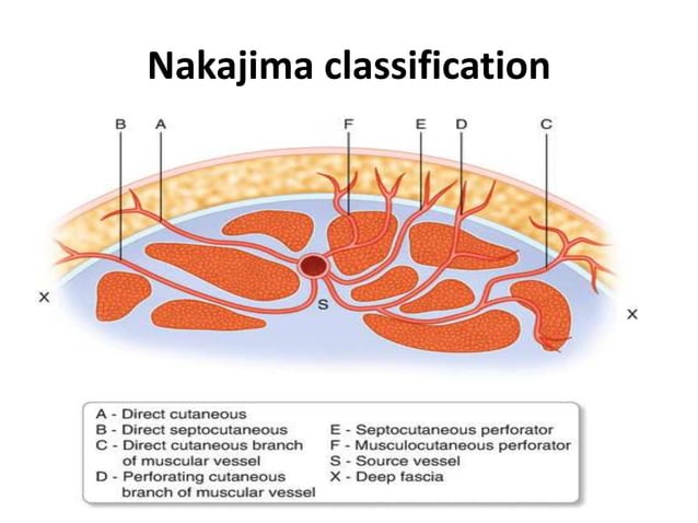 Classification of flaps | PPTX