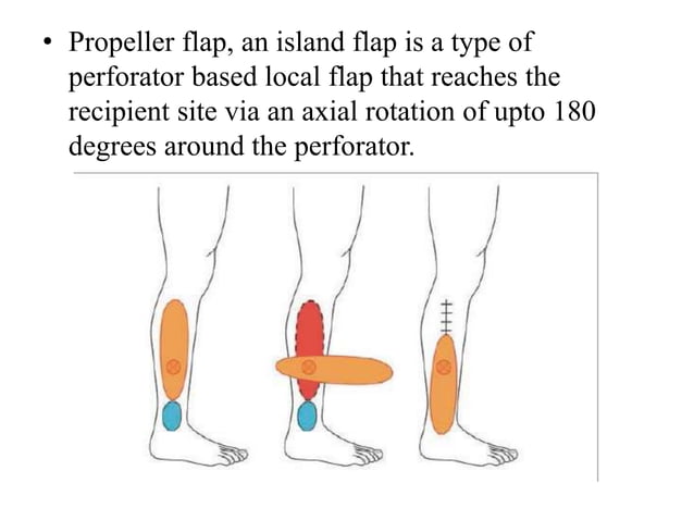 Classification of flaps | PPTX