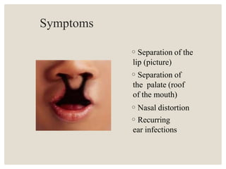 PPT_Cleftlip cleft palate_GI.pptx