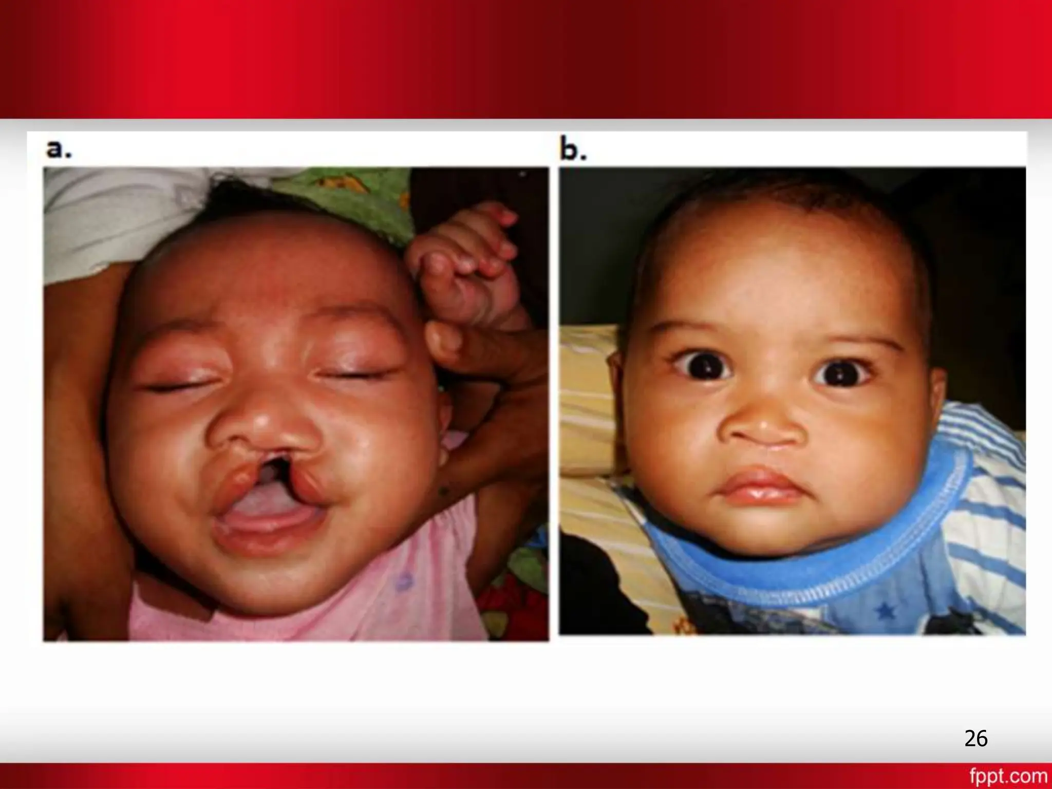 ppt sumbing dan tetap sumbing pptx oowow | PPT