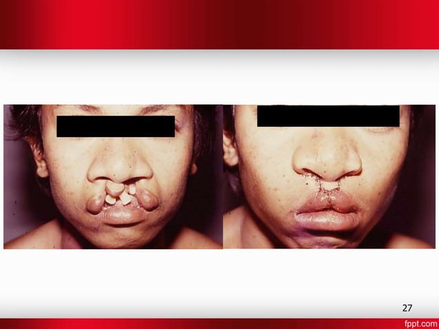 ppt sumbing dan tetap sumbing pptx oowow | PPT