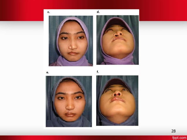 ppt sumbing dan tetap sumbing pptx oowow | PPT