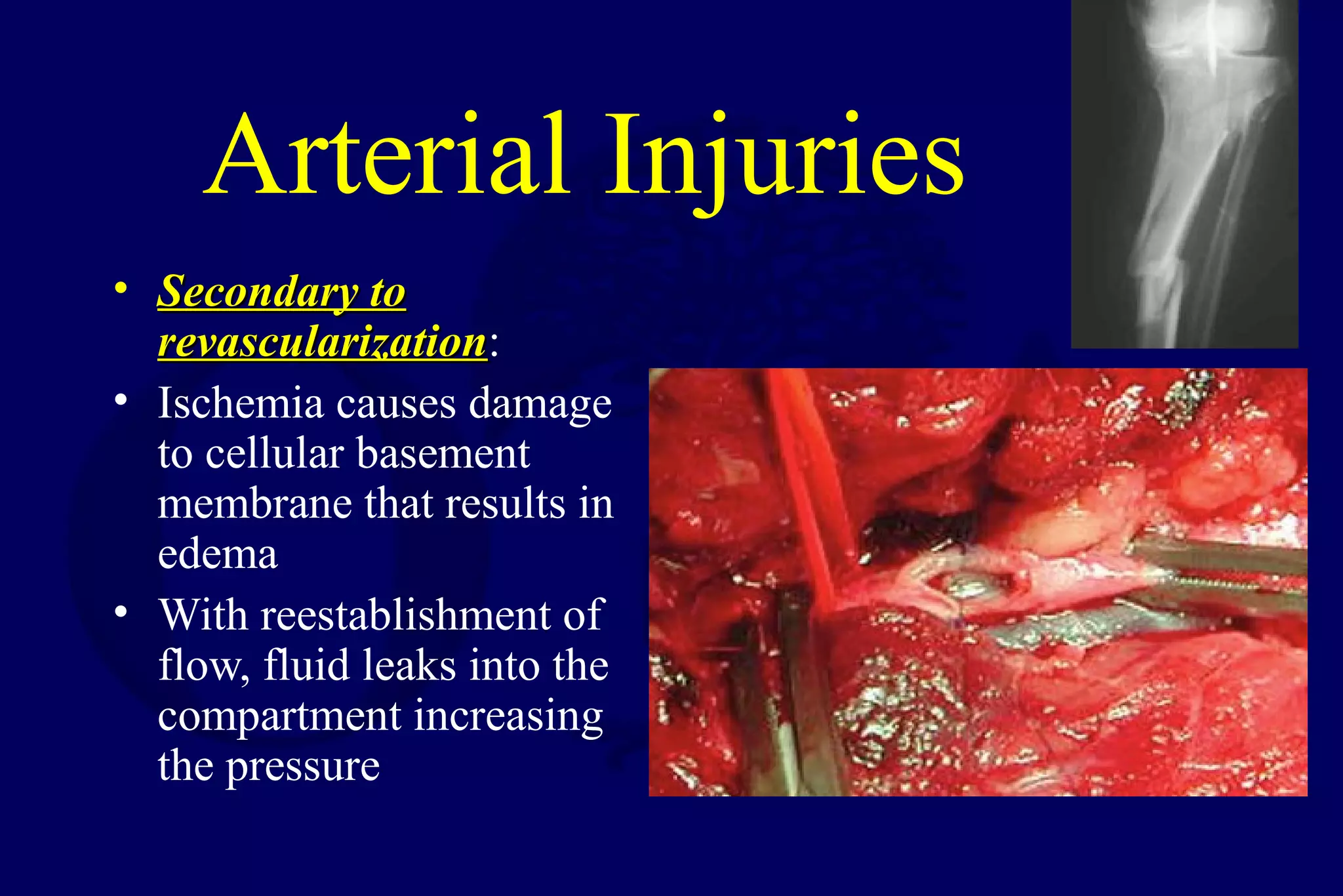 compartment syndrome | PPT