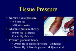compartment syndrome