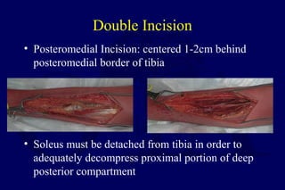 compartment syndrome | PPT