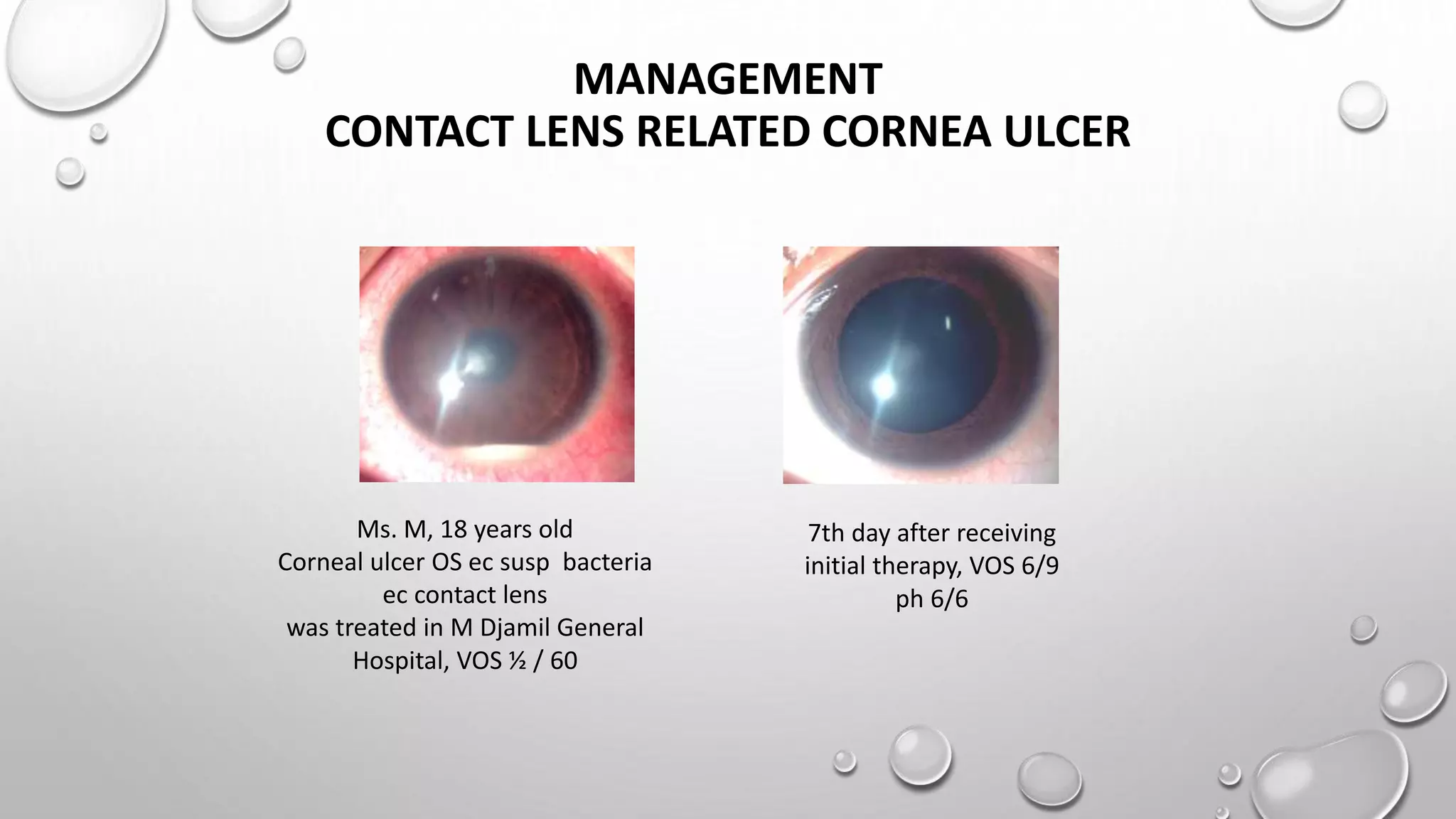 Ppt contact lens induced corneal ulcer | PPT