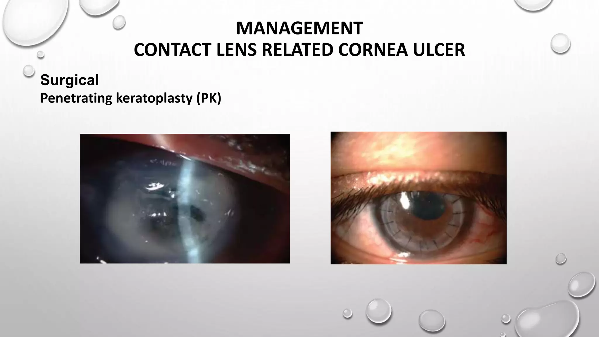 Ppt Contact Lens Induced Corneal Ulcer Ppt