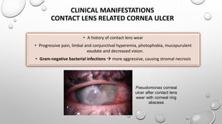 Ppt contact lens induced corneal ulcer | PPT