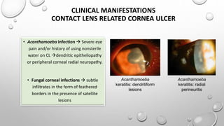 Ppt contact lens induced corneal ulcer | PPT