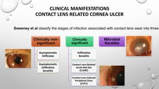 Ppt contact lens induced corneal ulcer | PPT