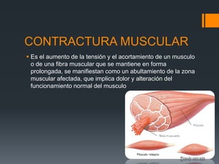 Ppt contracturas | PPTX