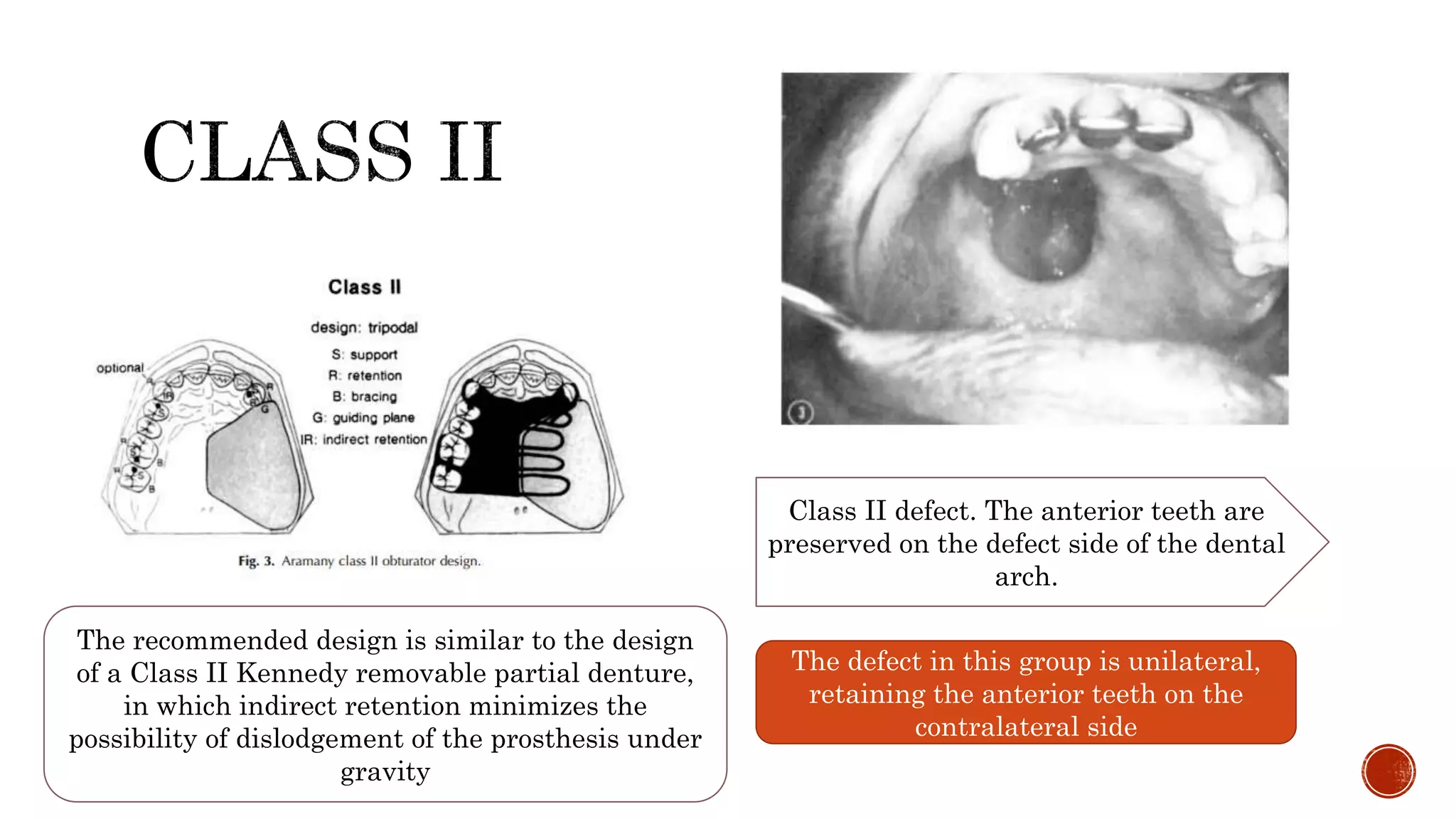 PROSTHODONTIC MANAGEMENT OF MAXILLECTOMY AND MANDIBULECTOMY PART 1 | PPTX