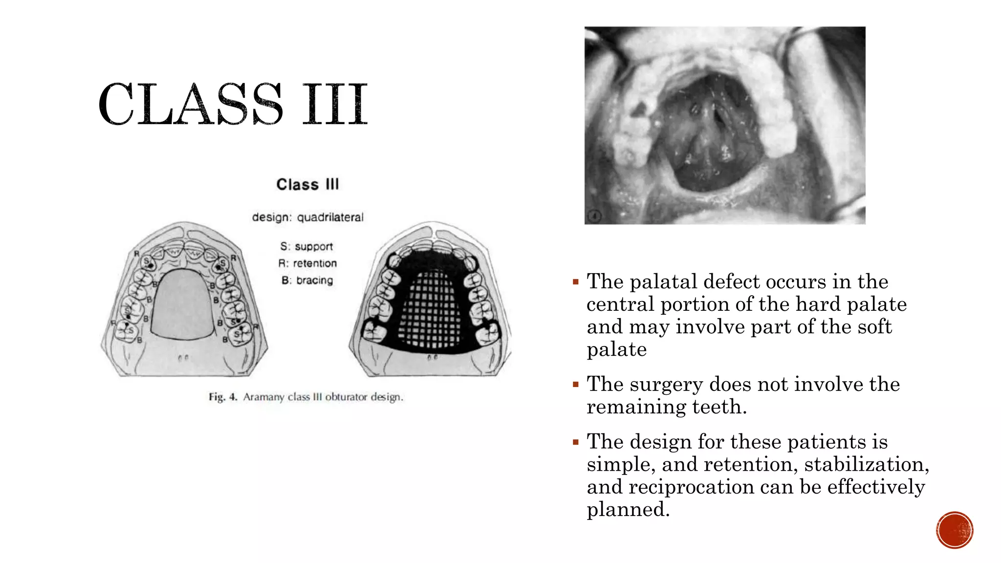 PROSTHODONTIC MANAGEMENT OF MAXILLECTOMY AND MANDIBULECTOMY PART 1 | PPTX