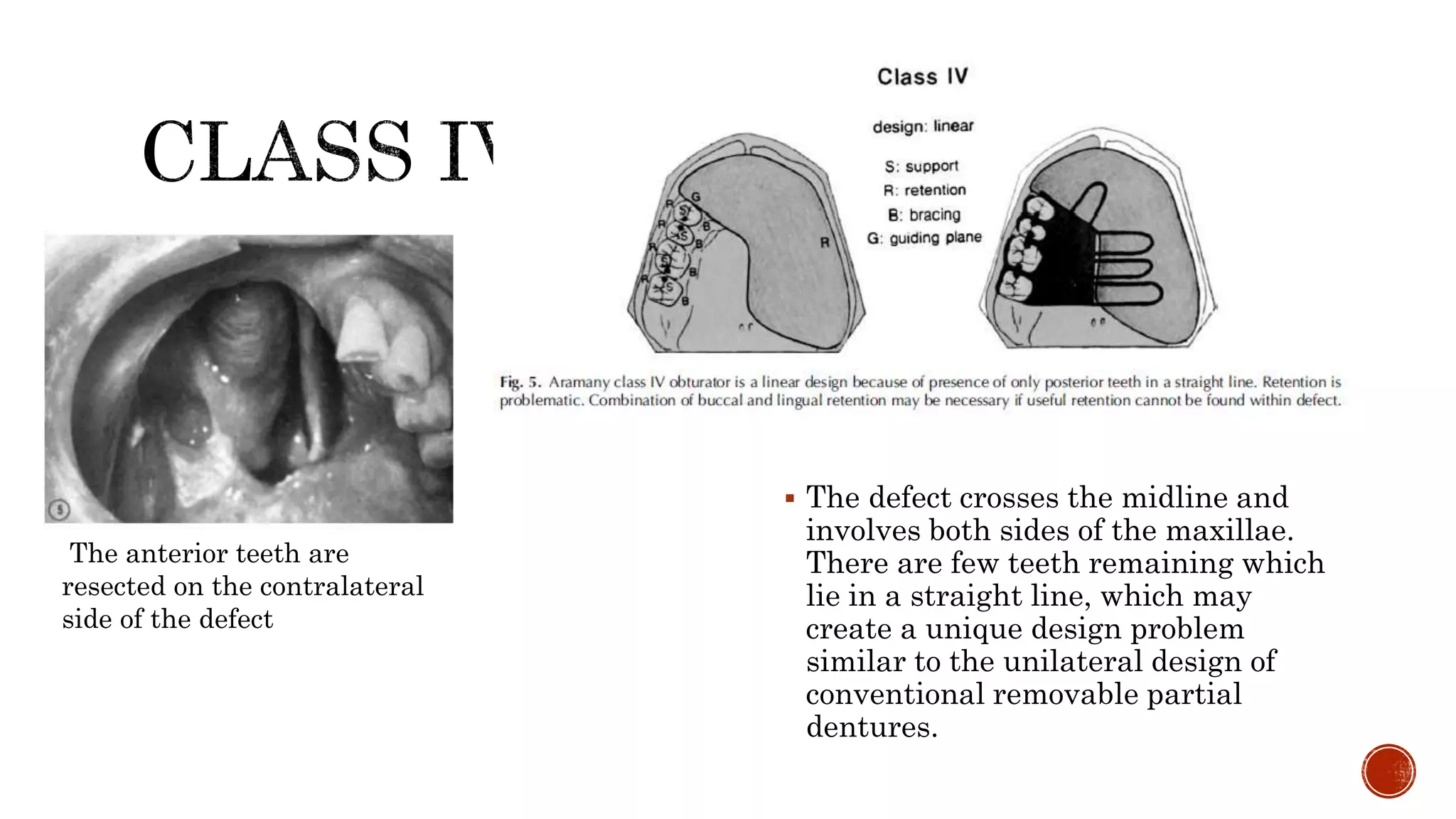 PROSTHODONTIC MANAGEMENT OF MAXILLECTOMY AND MANDIBULECTOMY PART 1 | PPTX