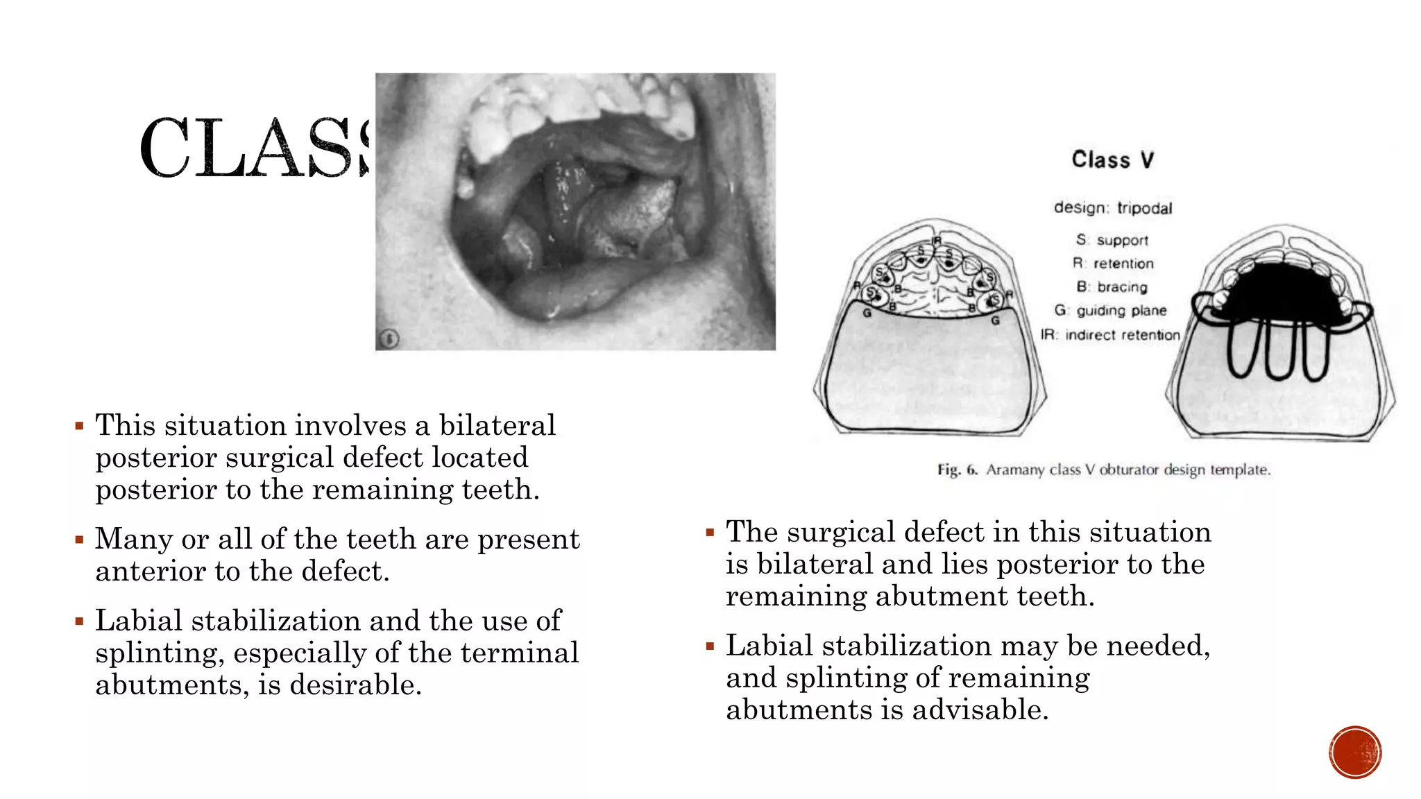 PROSTHODONTIC MANAGEMENT OF MAXILLECTOMY AND MANDIBULECTOMY PART 1 | PPTX