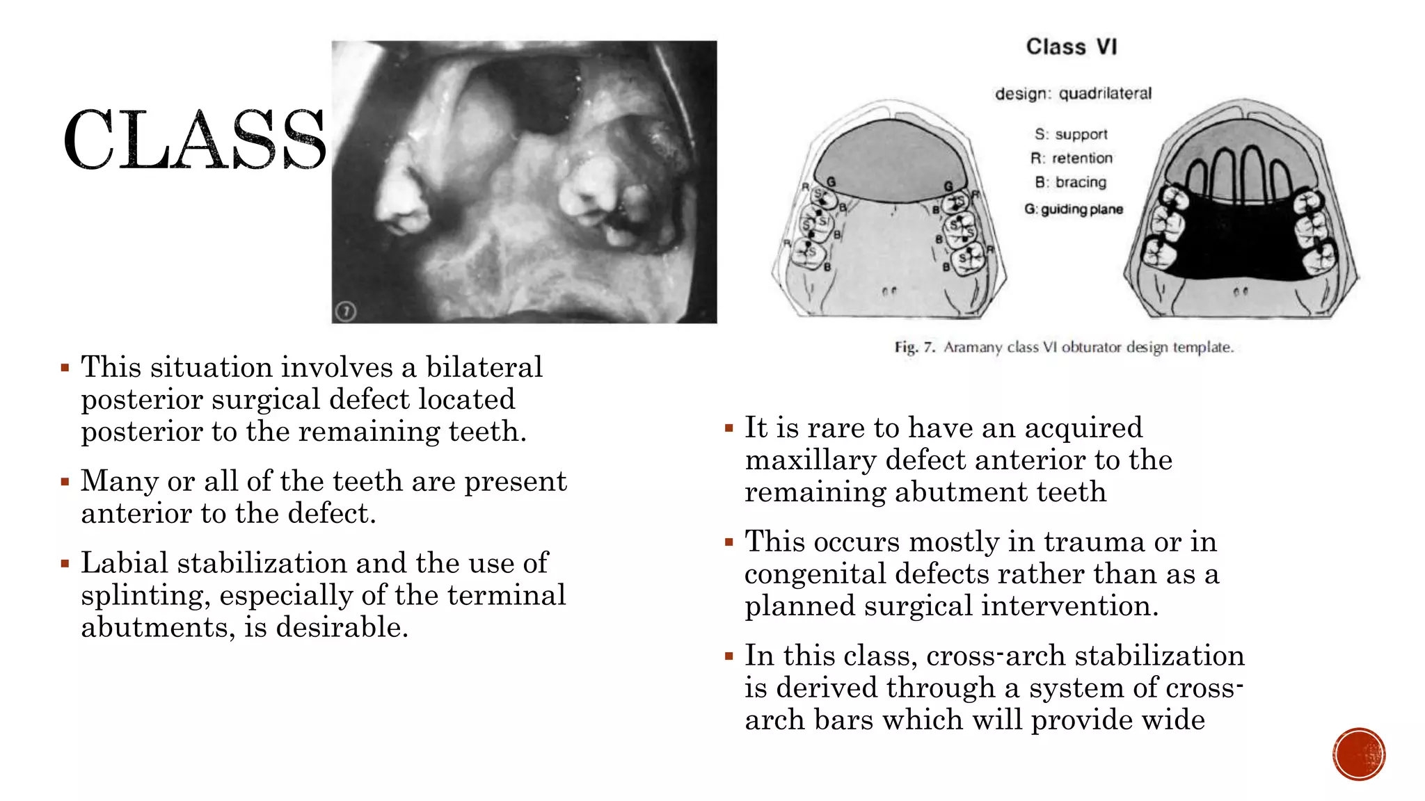 PROSTHODONTIC MANAGEMENT OF MAXILLECTOMY AND MANDIBULECTOMY PART 1 | PPTX