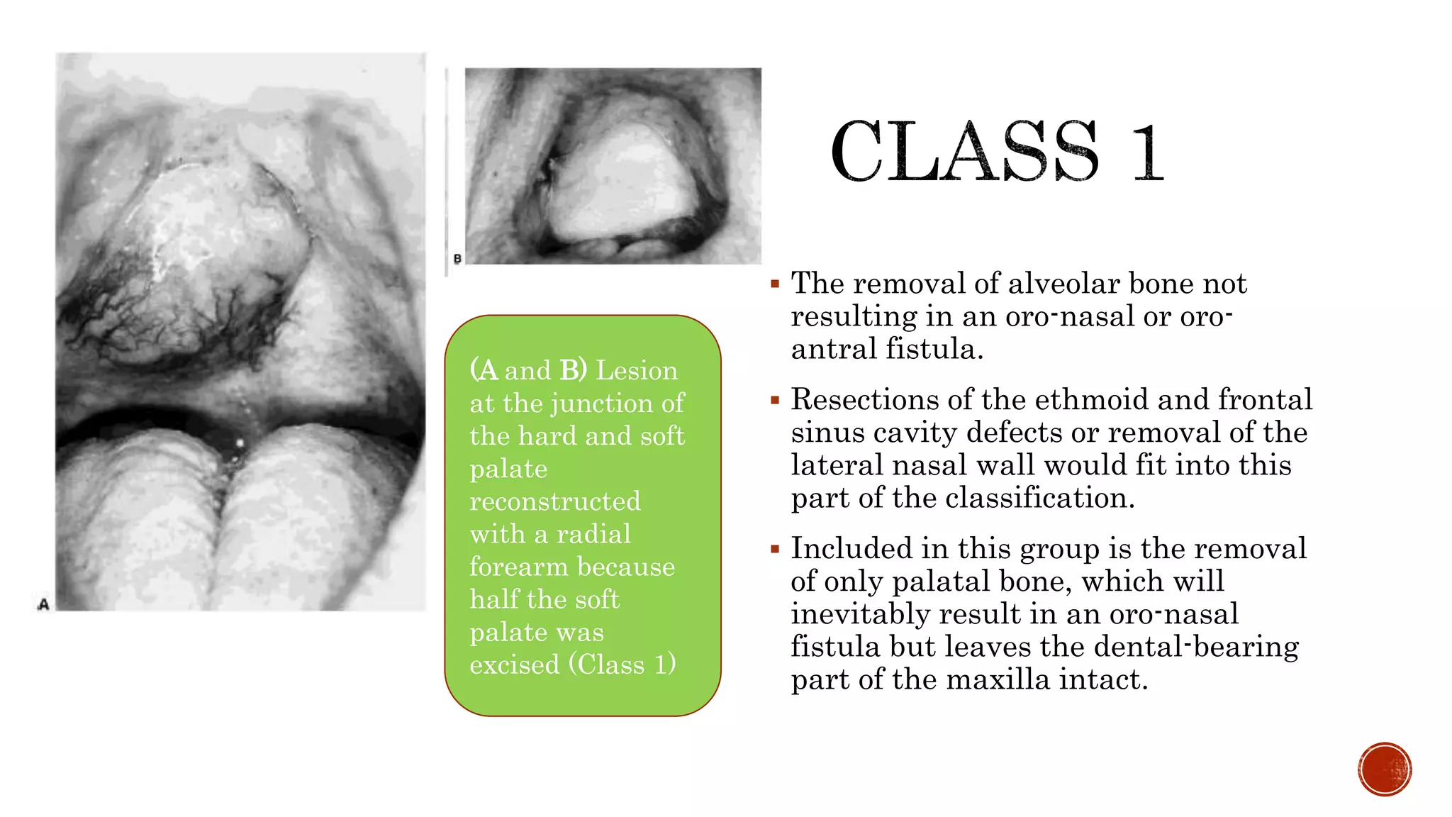 PROSTHODONTIC MANAGEMENT OF MAXILLECTOMY AND MANDIBULECTOMY PART 1 | PPTX