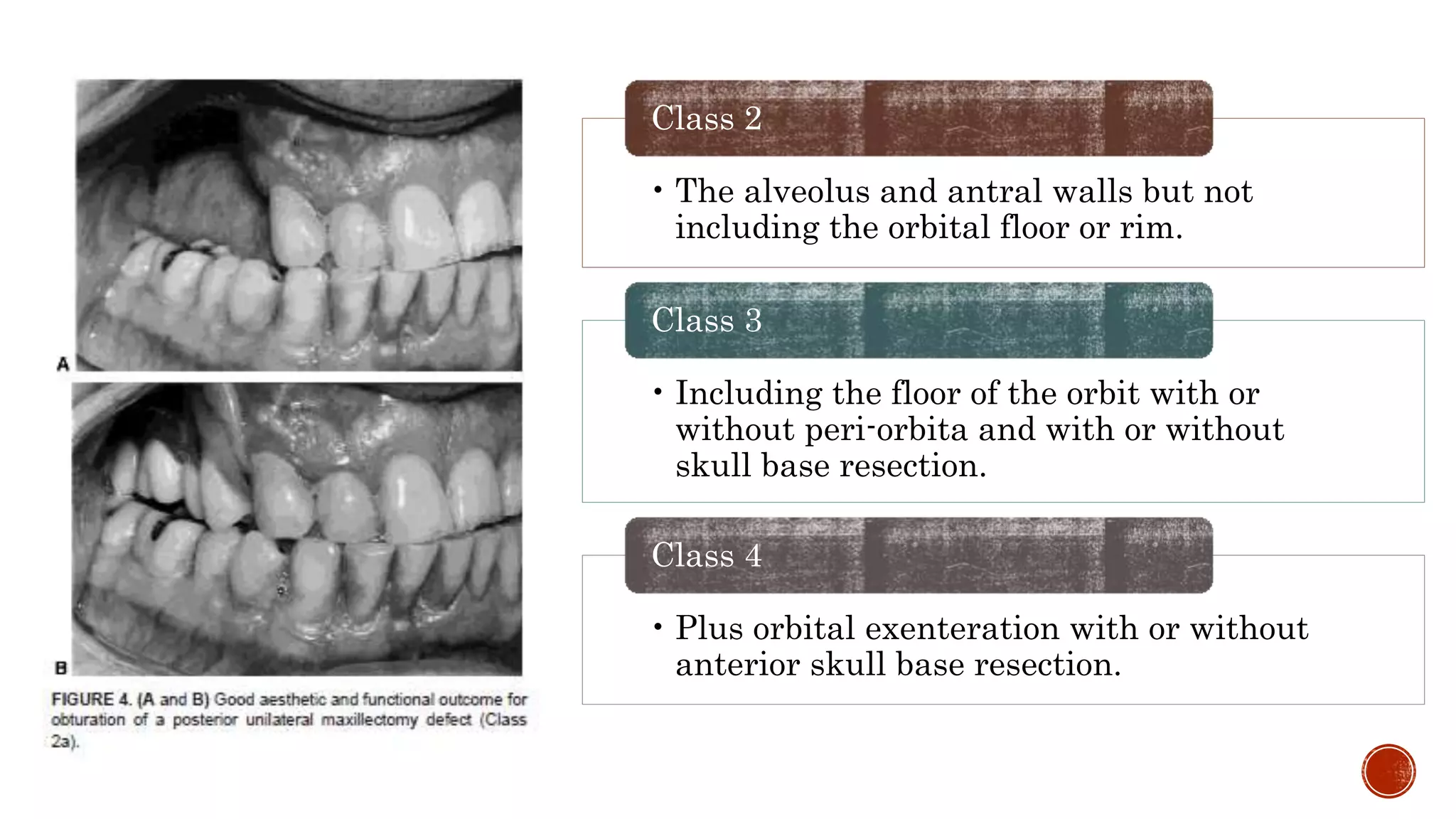 PROSTHODONTIC MANAGEMENT OF MAXILLECTOMY AND MANDIBULECTOMY PART 1 | PPTX