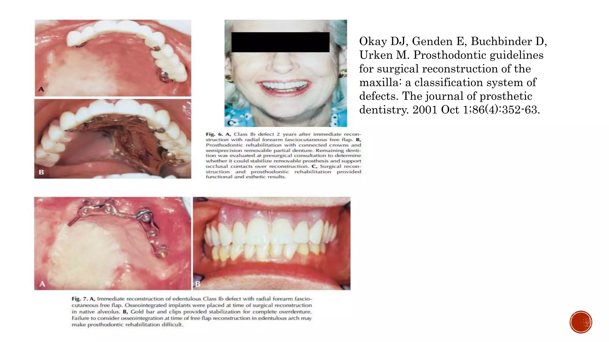 PROSTHODONTIC MANAGEMENT OF MAXILLECTOMY AND MANDIBULECTOMY PART 1 | PPTX