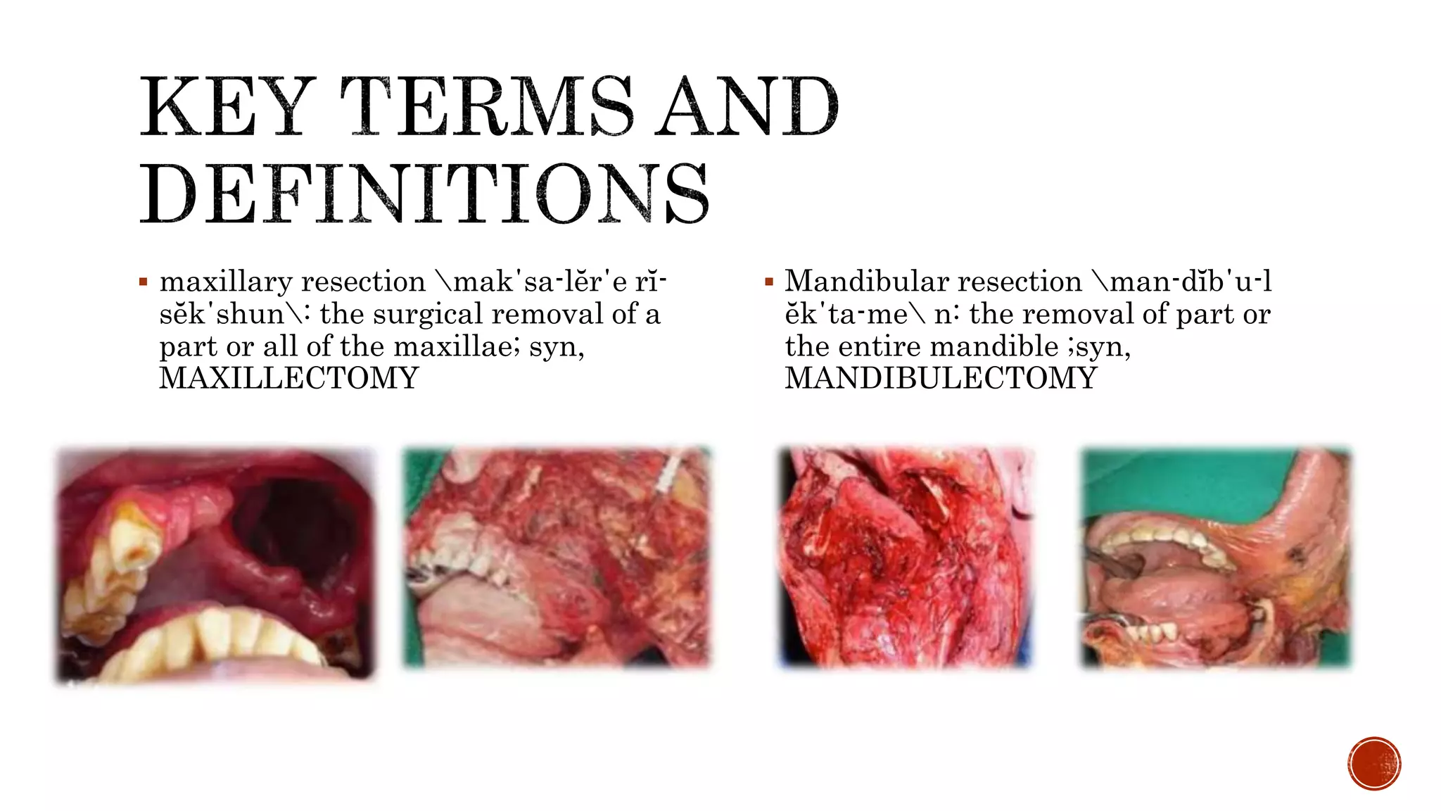 PROSTHODONTIC MANAGEMENT OF MAXILLECTOMY AND MANDIBULECTOMY PART 1 | PPTX