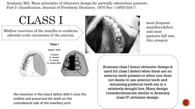 PROSTHODONTIC MANAGEMENT OF MAXILLECTOMY AND MANDIBULECTOMY PART 1 ...