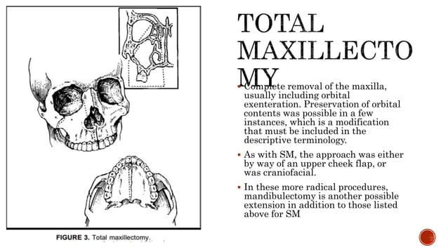 PROSTHODONTIC MANAGEMENT OF MAXILLECTOMY AND MANDIBULECTOMY PART 1 ...