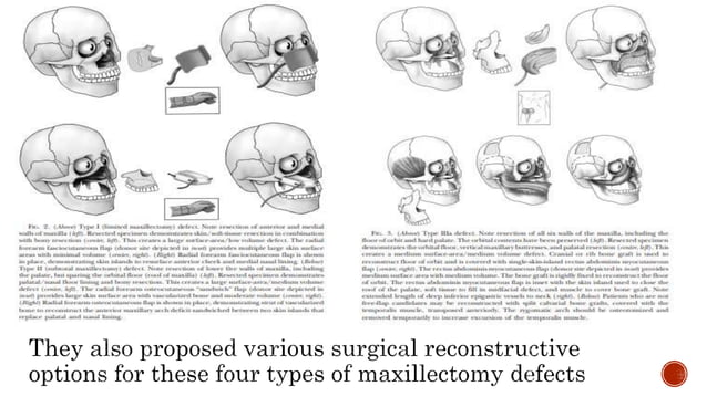 PROSTHODONTIC MANAGEMENT OF MAXILLECTOMY AND MANDIBULECTOMY PART 1 ...