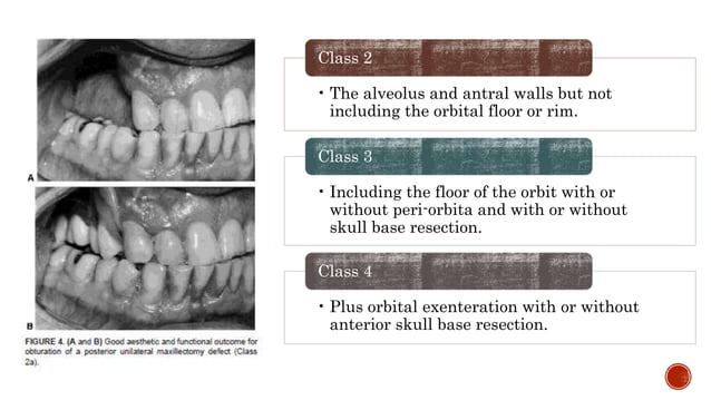 PROSTHODONTIC MANAGEMENT OF MAXILLECTOMY AND MANDIBULECTOMY PART 1 ...