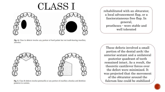 PROSTHODONTIC MANAGEMENT OF MAXILLECTOMY AND MANDIBULECTOMY PART 1 ...