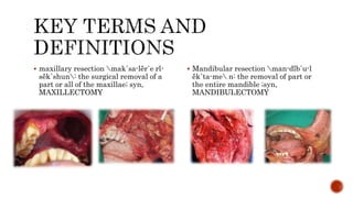 PROSTHODONTIC MANAGEMENT OF MAXILLECTOMY AND MANDIBULECTOMY PART 1 | PPTX