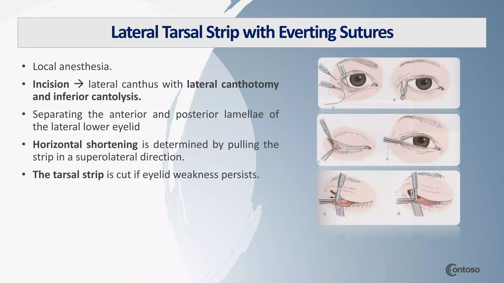 A Comparison of The Lateral Tarsal Strip with Everting Sutures and The ...