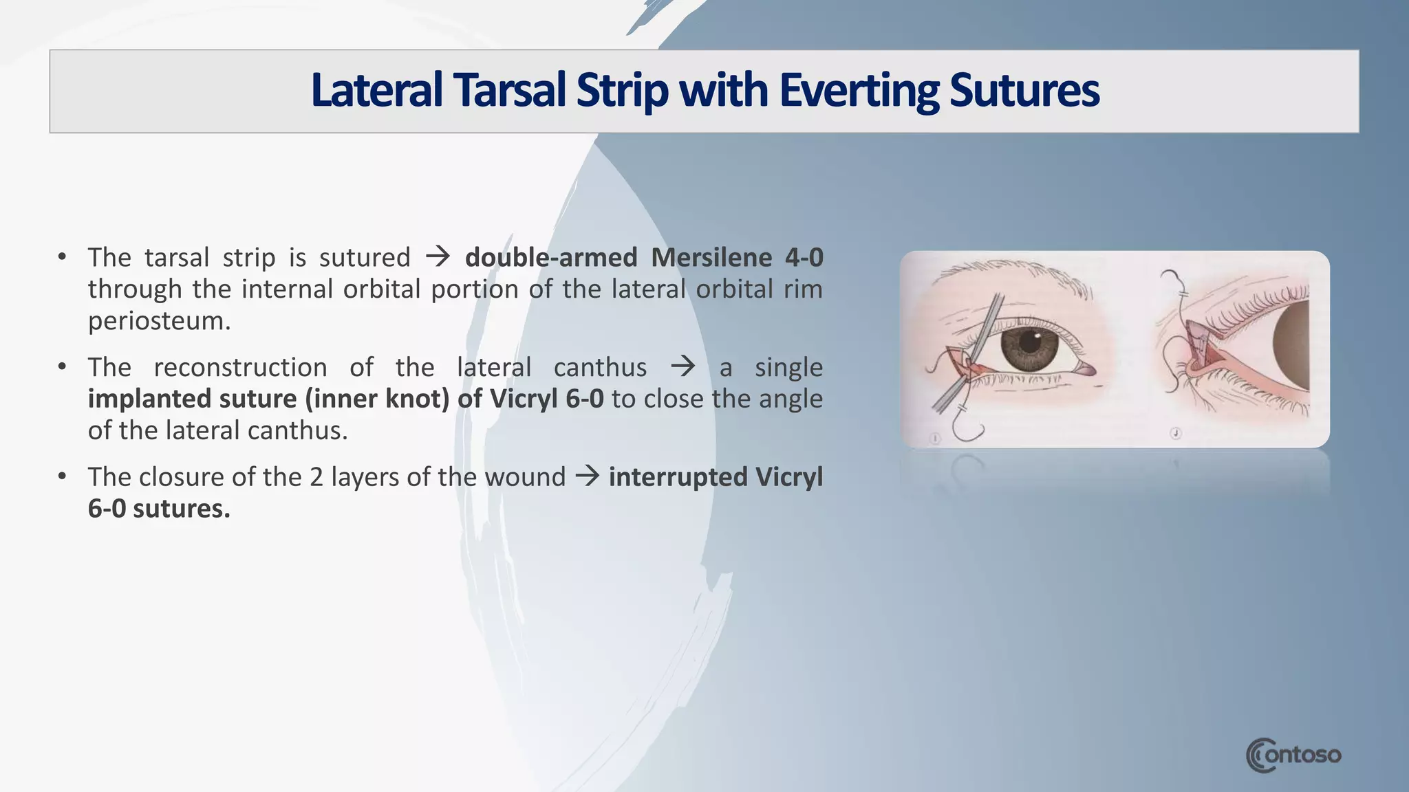 A Comparison of The Lateral Tarsal Strip with Everting Sutures and The ...