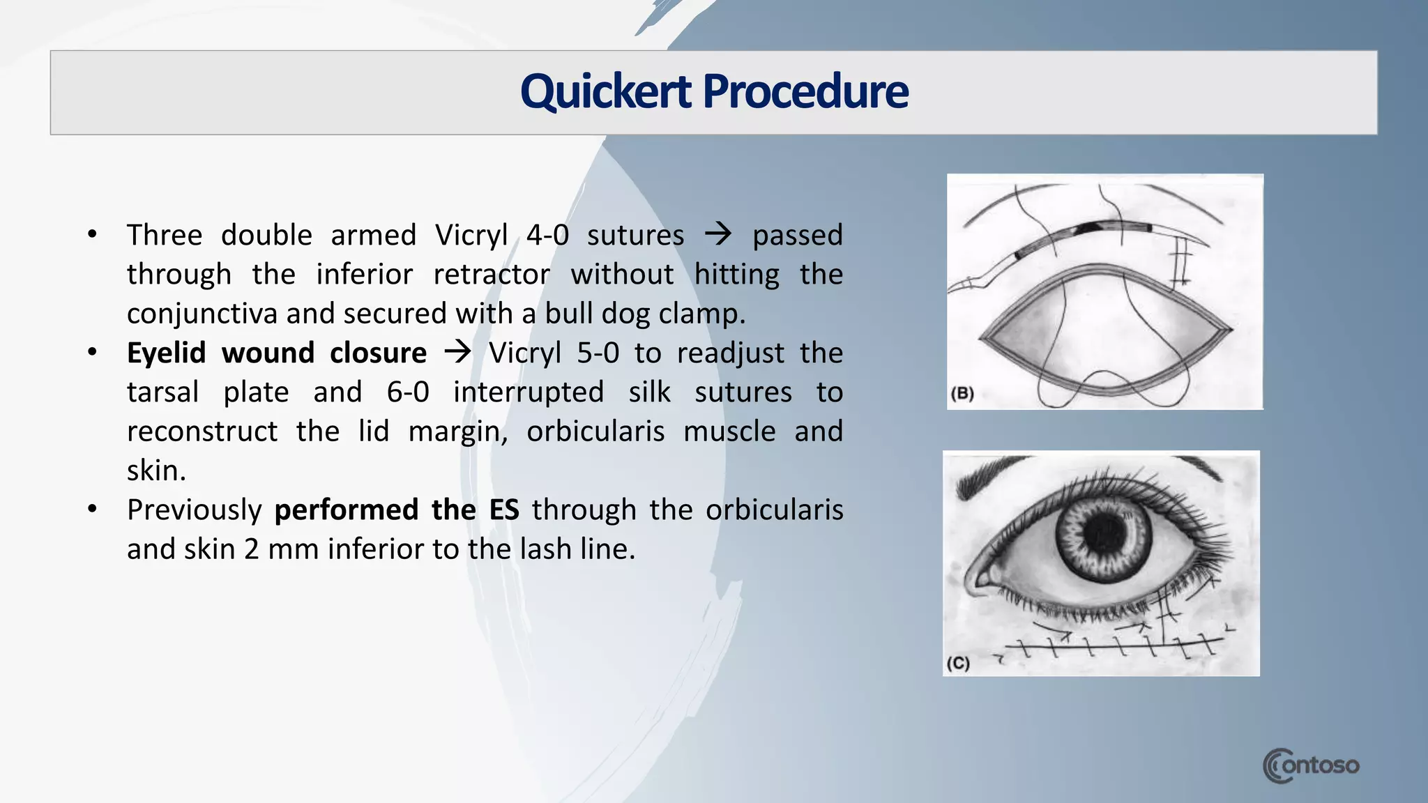 A Comparison of The Lateral Tarsal Strip with Everting Sutures and The ...