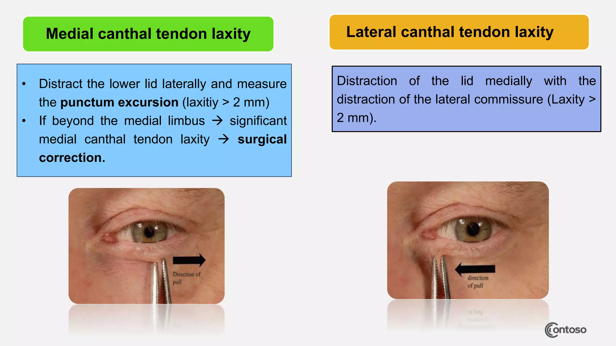 A Comparison of The Lateral Tarsal Strip with Everting Sutures and The ...