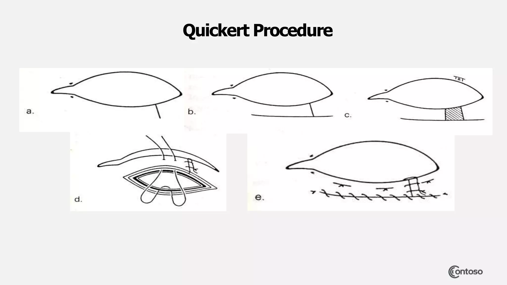A Comparison of The Lateral Tarsal Strip with Everting Sutures and The ...