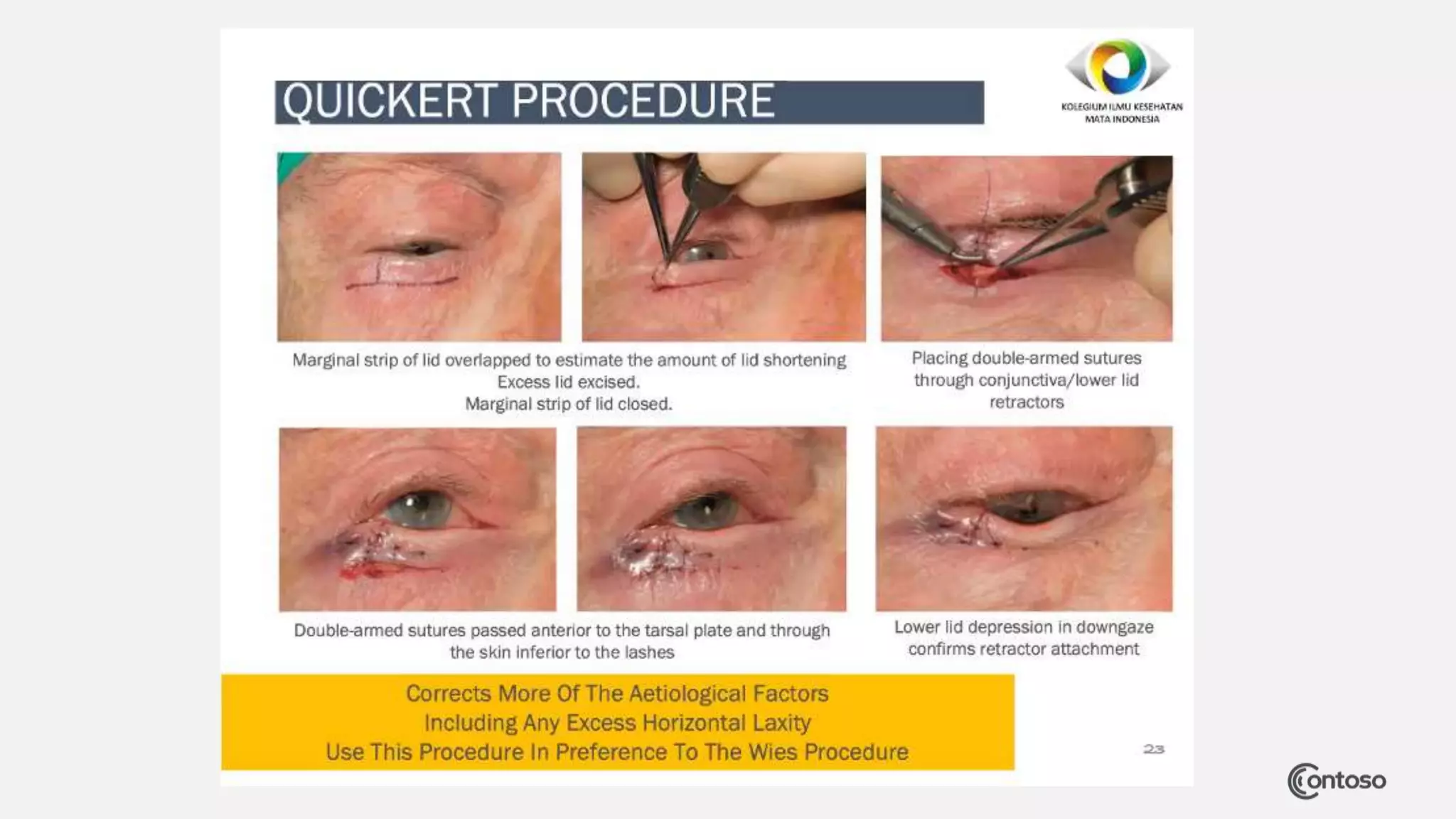 A Comparison of The Lateral Tarsal Strip with Everting Sutures and The ...