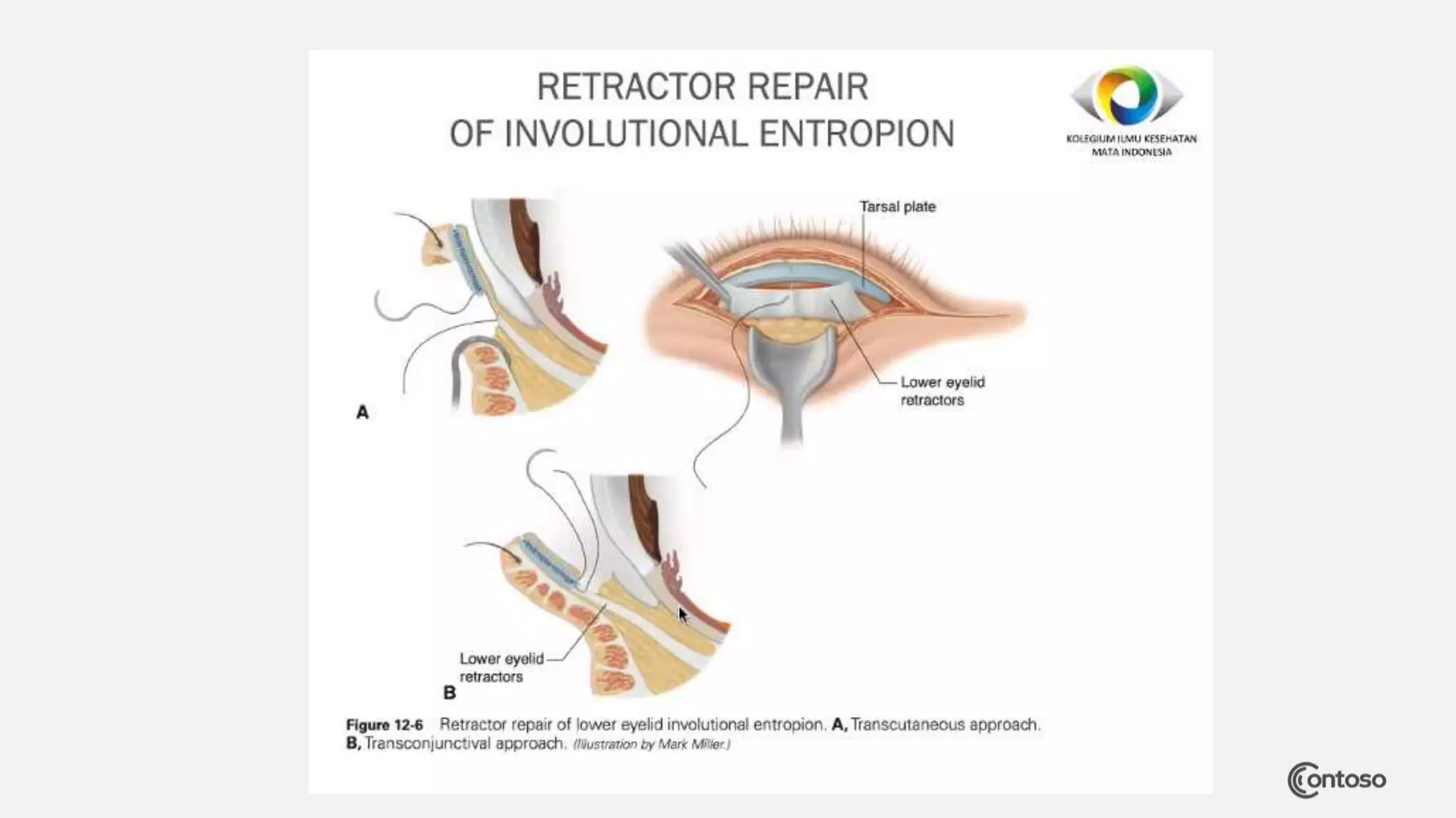 A Comparison of The Lateral Tarsal Strip with Everting Sutures and The ...