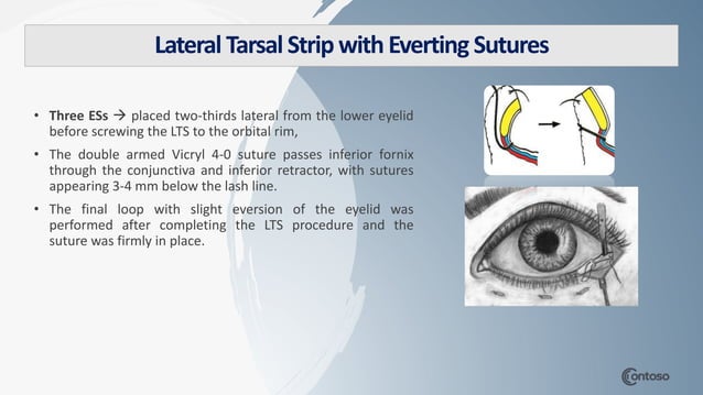 A Comparison of The Lateral Tarsal Strip with Everting Sutures and The ...