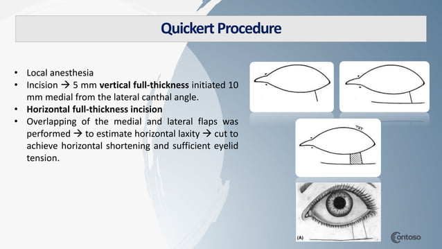 A Comparison of The Lateral Tarsal Strip with Everting Sutures and The ...