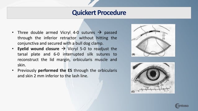 A Comparison of The Lateral Tarsal Strip with Everting Sutures and The ...