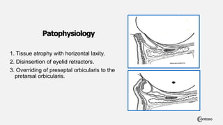 A Comparison of The Lateral Tarsal Strip with Everting Sutures and The ...