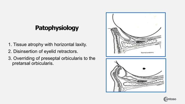 A Comparison of The Lateral Tarsal Strip with Everting Sutures and The ...
