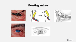 A Comparison of The Lateral Tarsal Strip with Everting Sutures and The ...