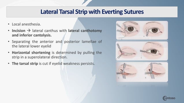 A Comparison of The Lateral Tarsal Strip with Everting Sutures and The ...