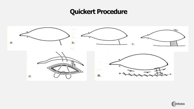 A Comparison of The Lateral Tarsal Strip with Everting Sutures and The ...