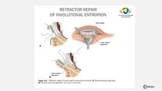 A Comparison of The Lateral Tarsal Strip with Everting Sutures and The ...