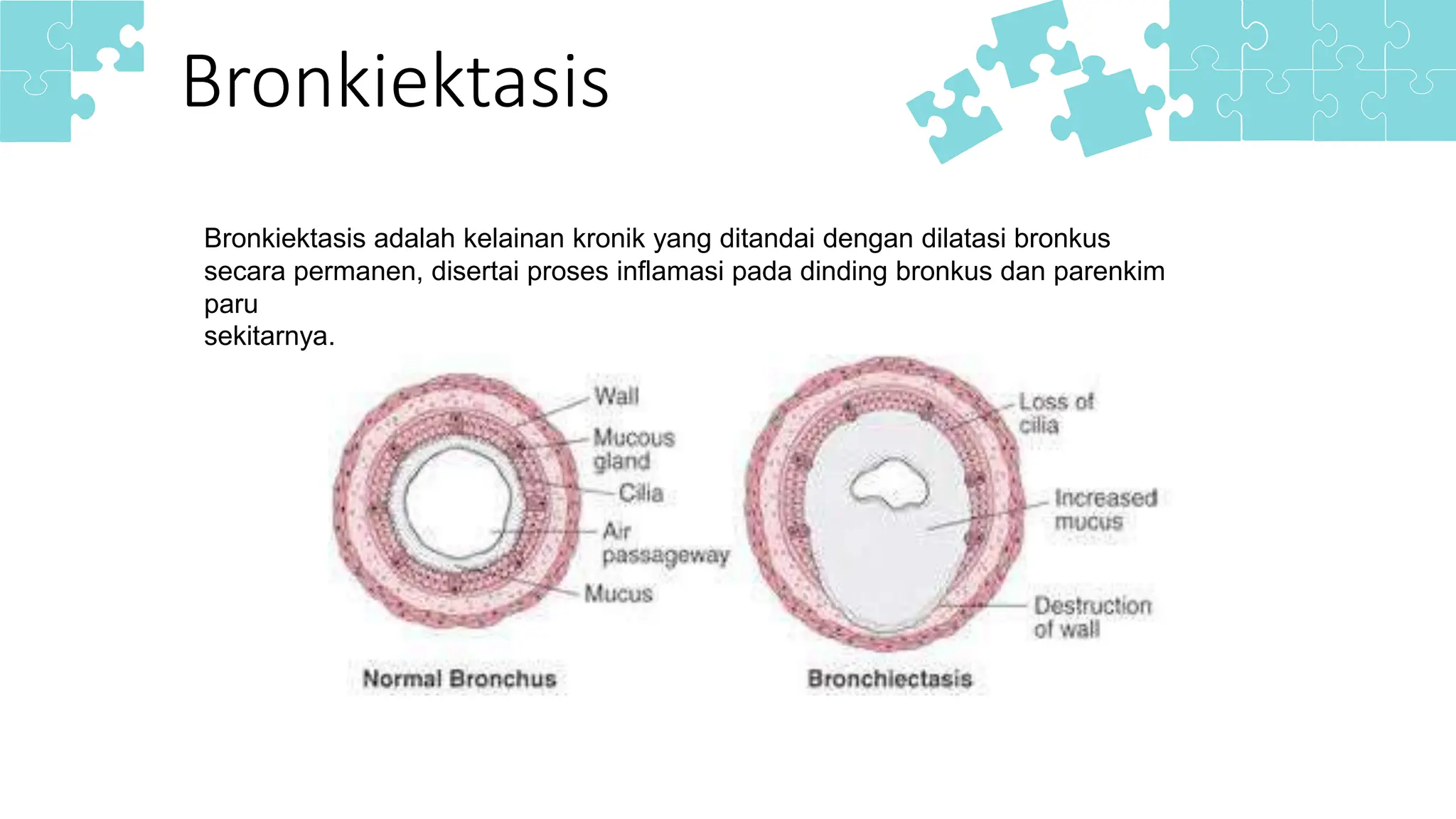 Case Report Session - Pulmonary Bronkiektasis | PPTX