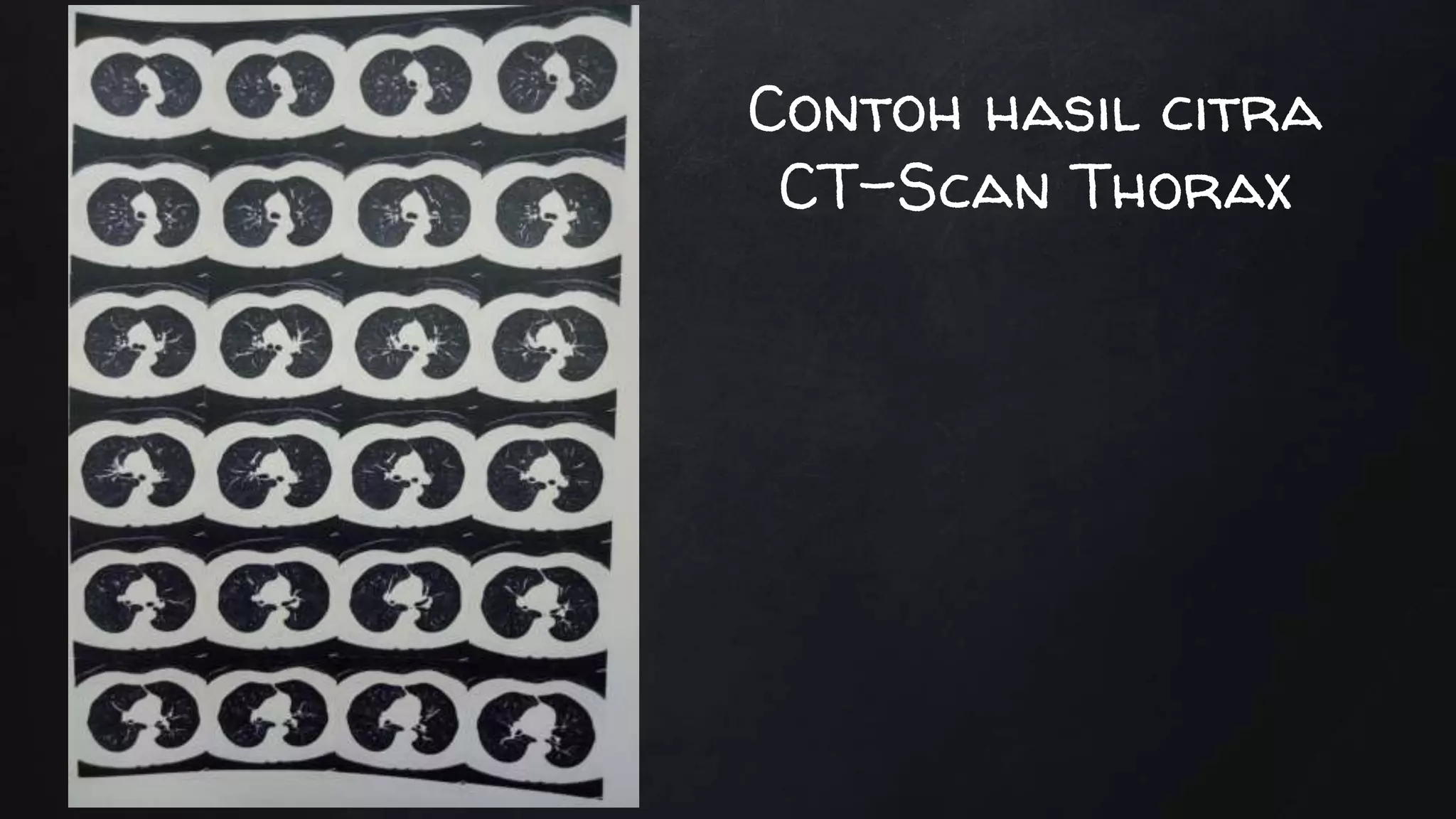 Ppt ct scan thorax pada kasus asma | PPTX