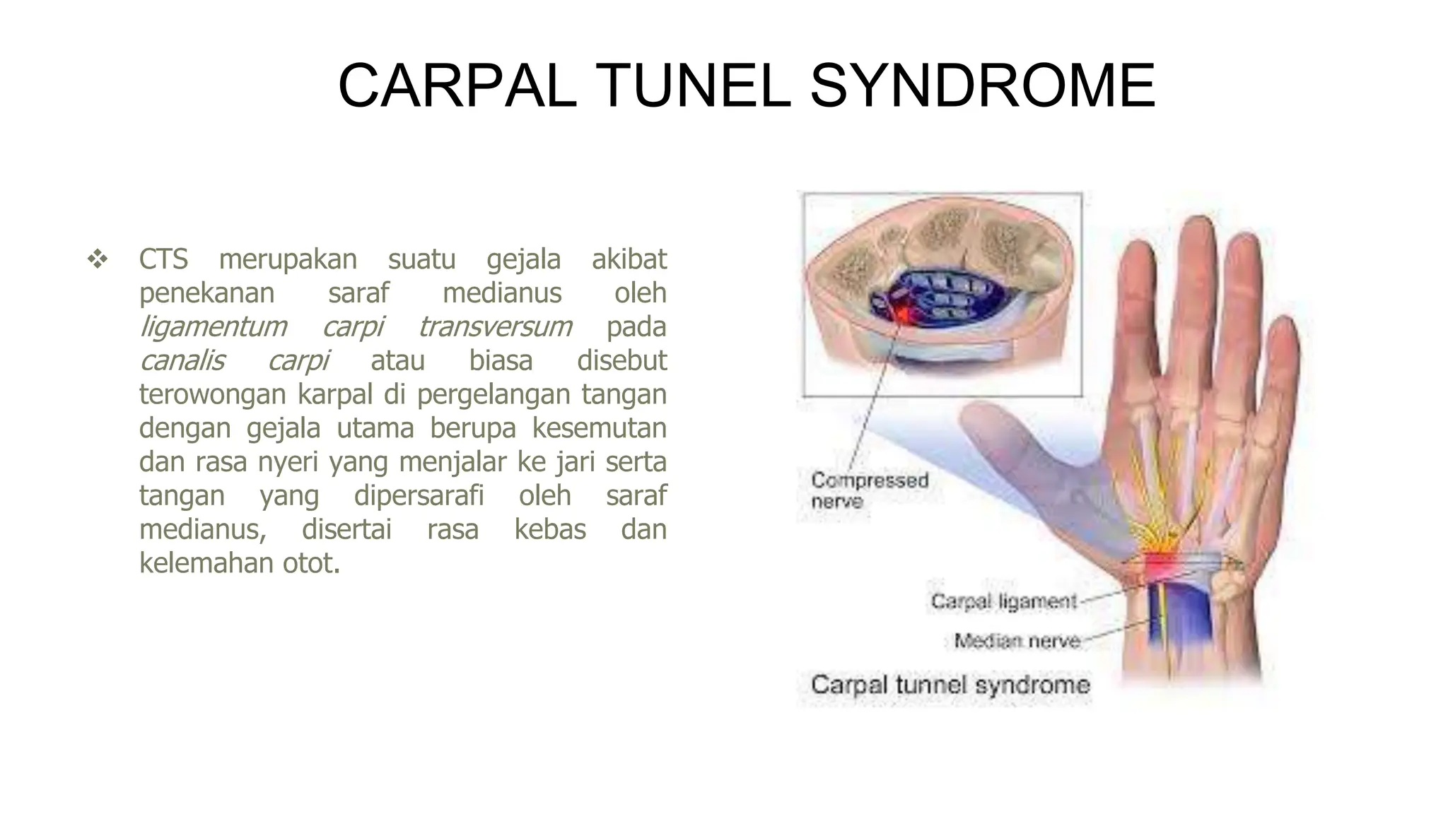 PRESENTASI CARPAL TUNNEL SYNDROME .pptx